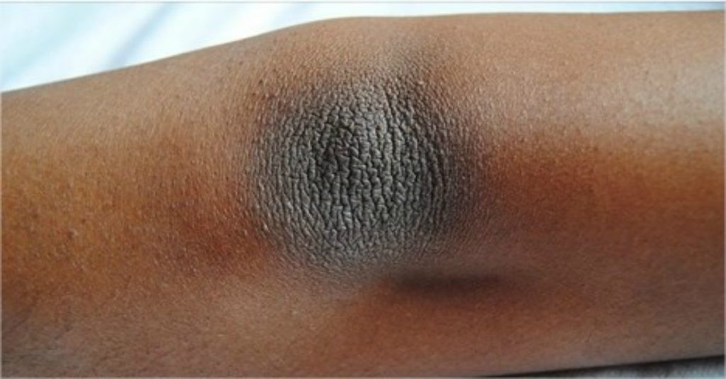 Aprende A Eliminar Las Horribles Manchas Oscuras Que Aparecen En Los ...