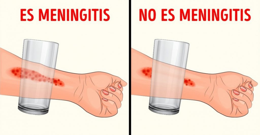 8 Síntomas De La Meningitis Que Ningún Padre Debería Pasar Por Alto ...